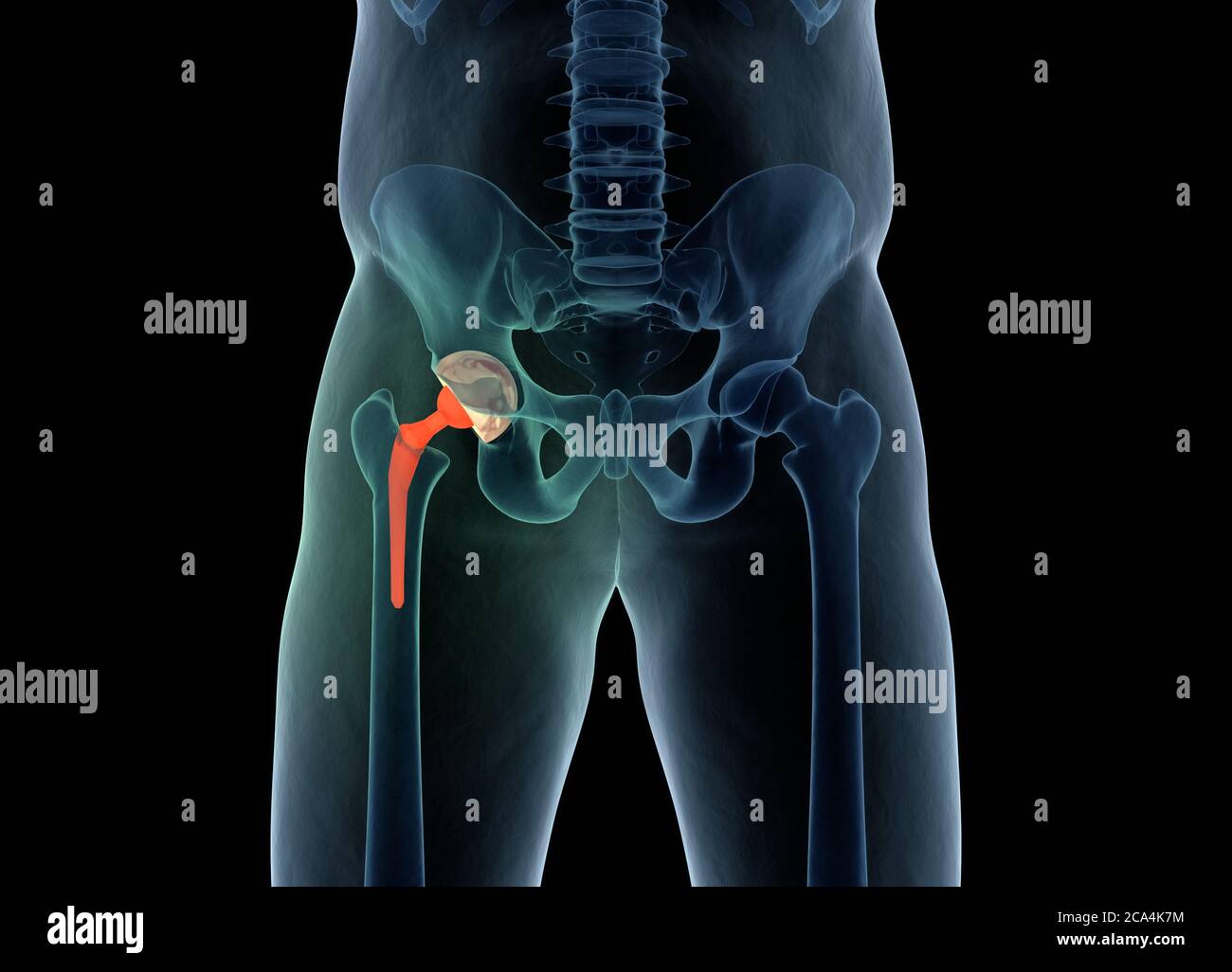 Medically accurate illustration of the hip replacement. 3d illustration ...