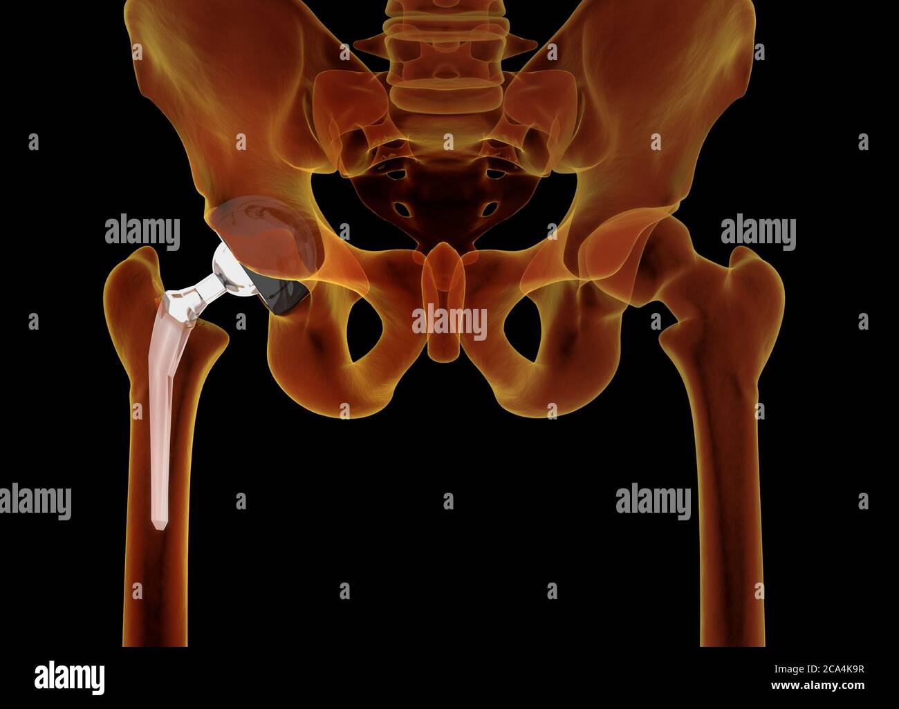 Medically accurate illustration of the hip replacement. 3d illustration ...