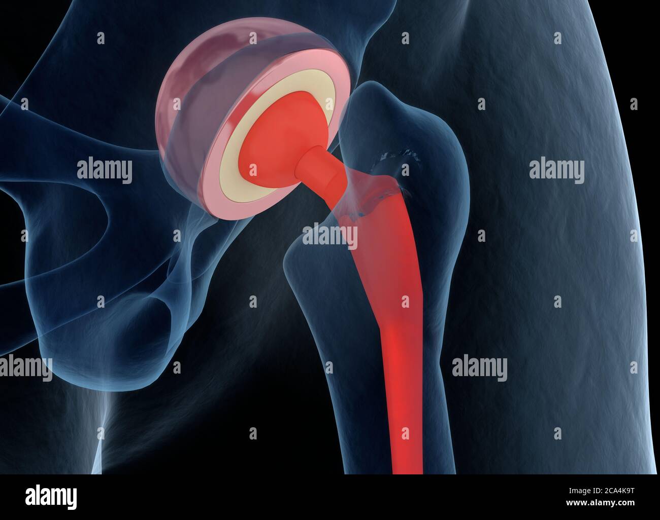 Medically accurate illustration of the hip replacement. 3d illustration ...