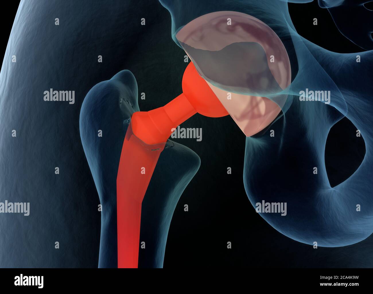 Medically accurate illustration of the hip replacement. 3d illustration ...
