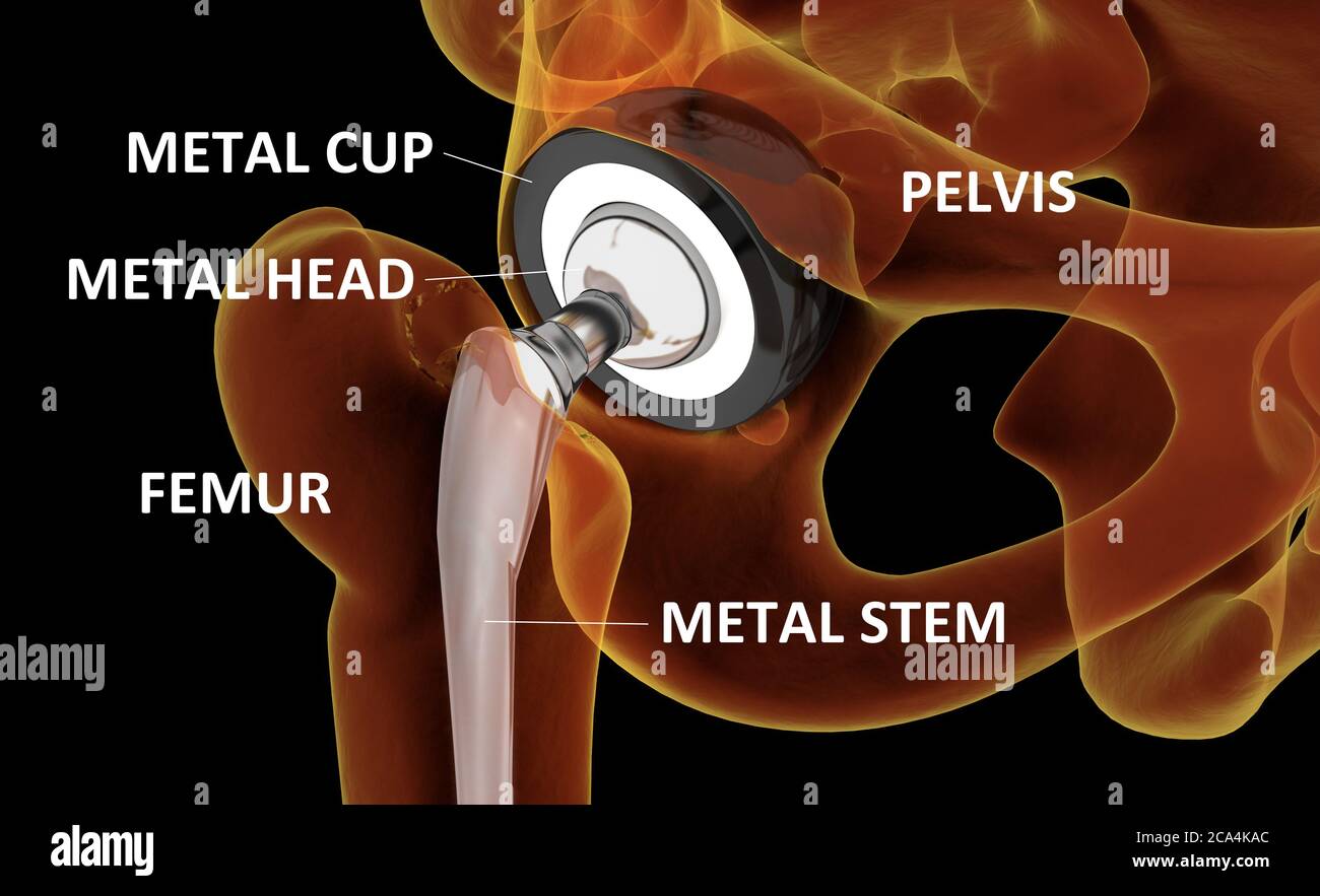Medically accurate illustration of the hip replacement. 3d illustration ...