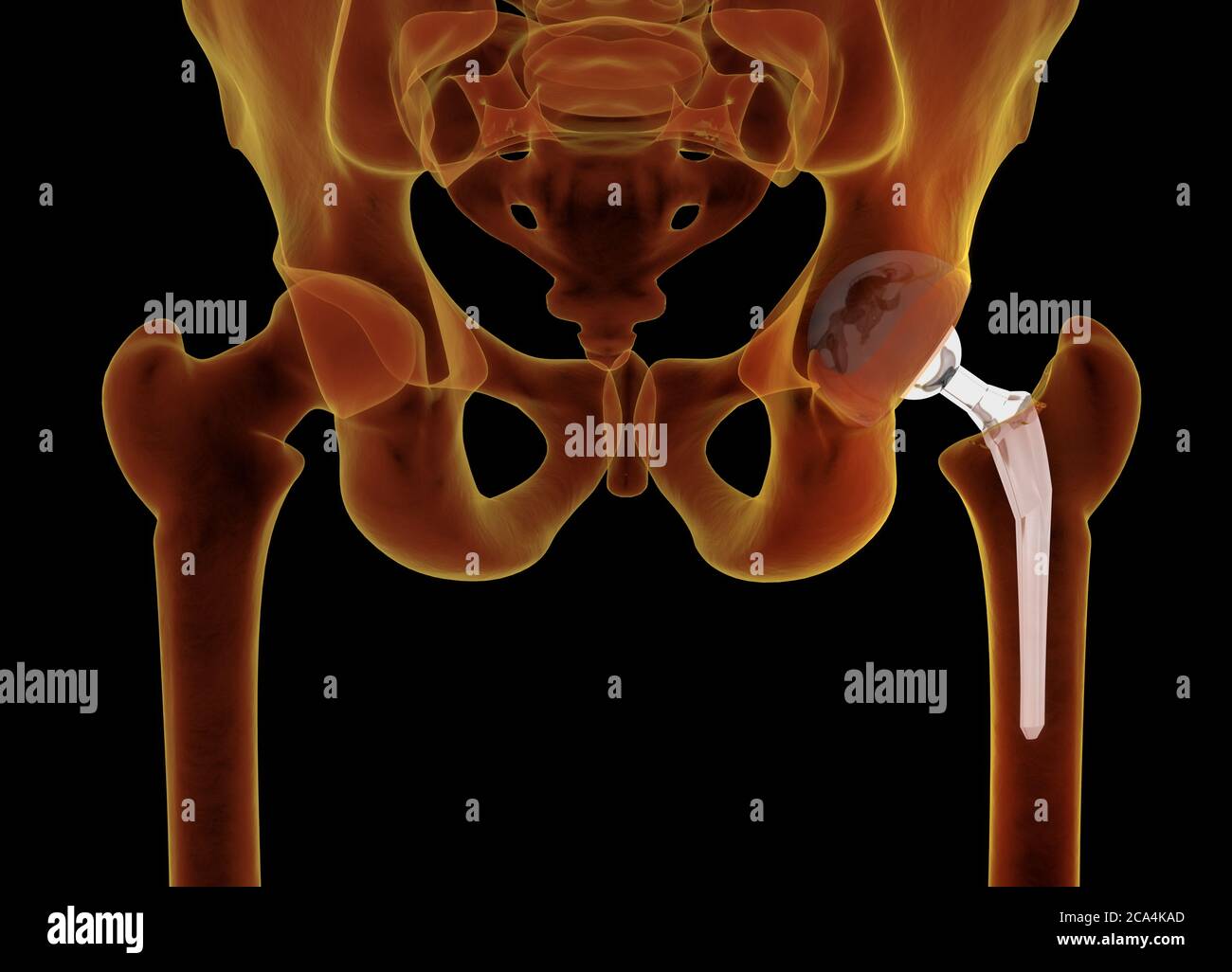 Medically accurate illustration of the hip replacement. 3d illustration ...