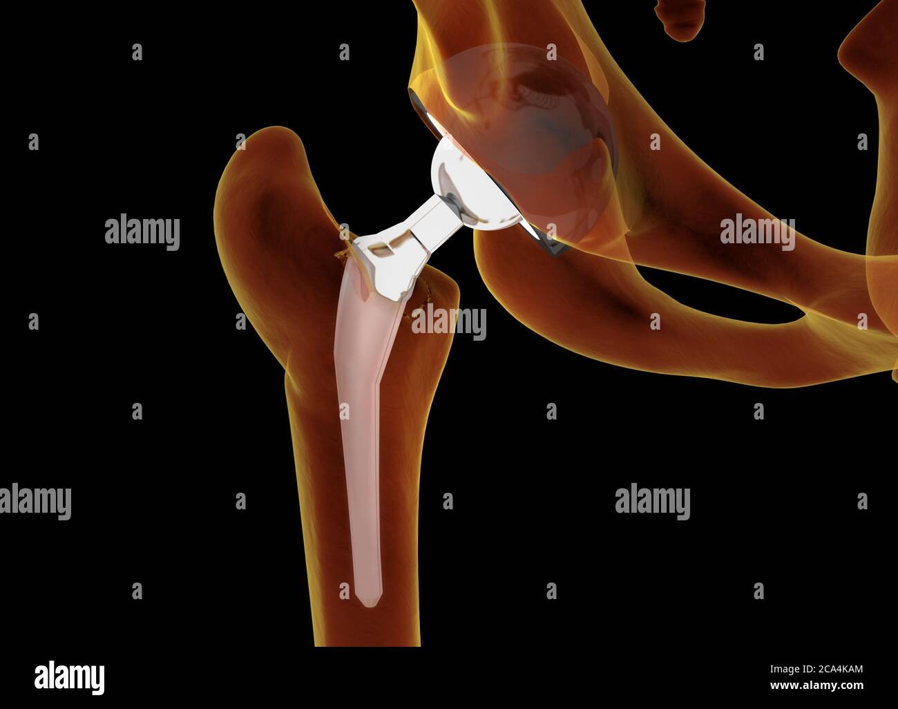 Medically accurate illustration of the hip replacement. 3d illustration ...