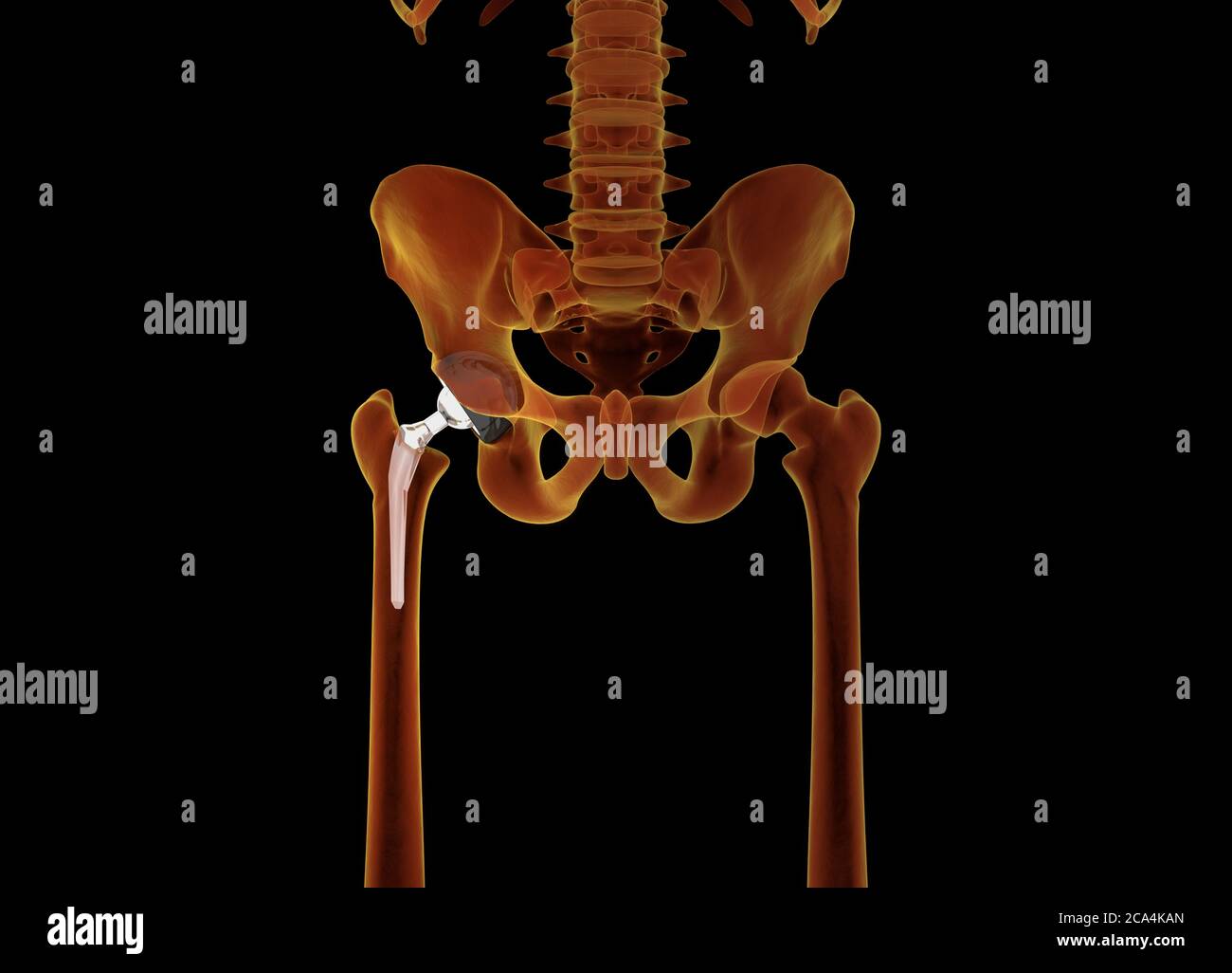 Medically accurate illustration of the hip replacement. 3d illustration ...