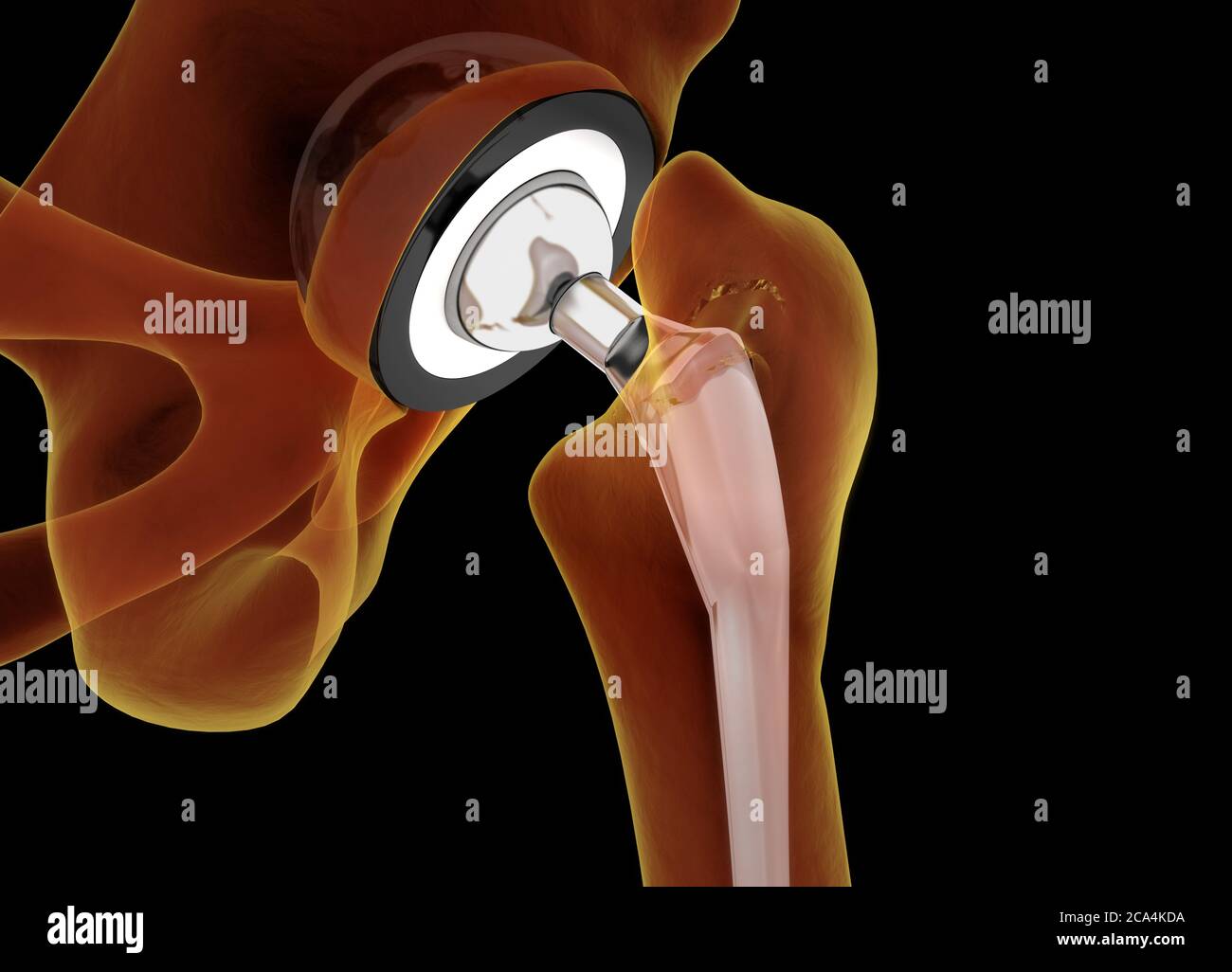Medically accurate illustration of the hip replacement. 3d illustration ...