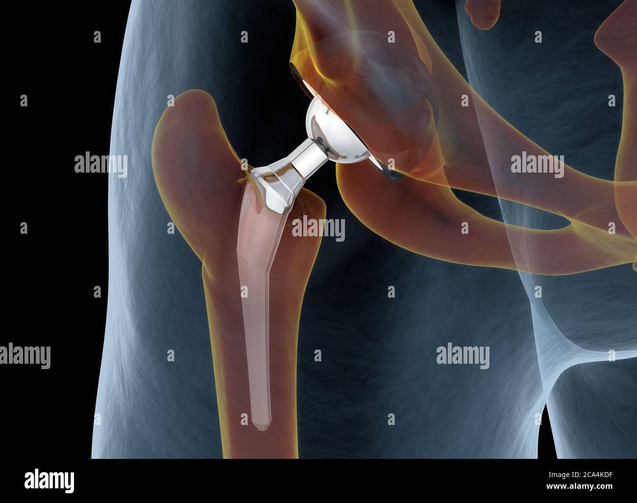 Medically accurate illustration of the hip replacement. 3d illustration ...