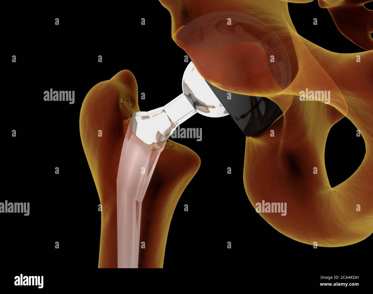 Medically accurate illustration of the hip replacement. 3d illustration ...