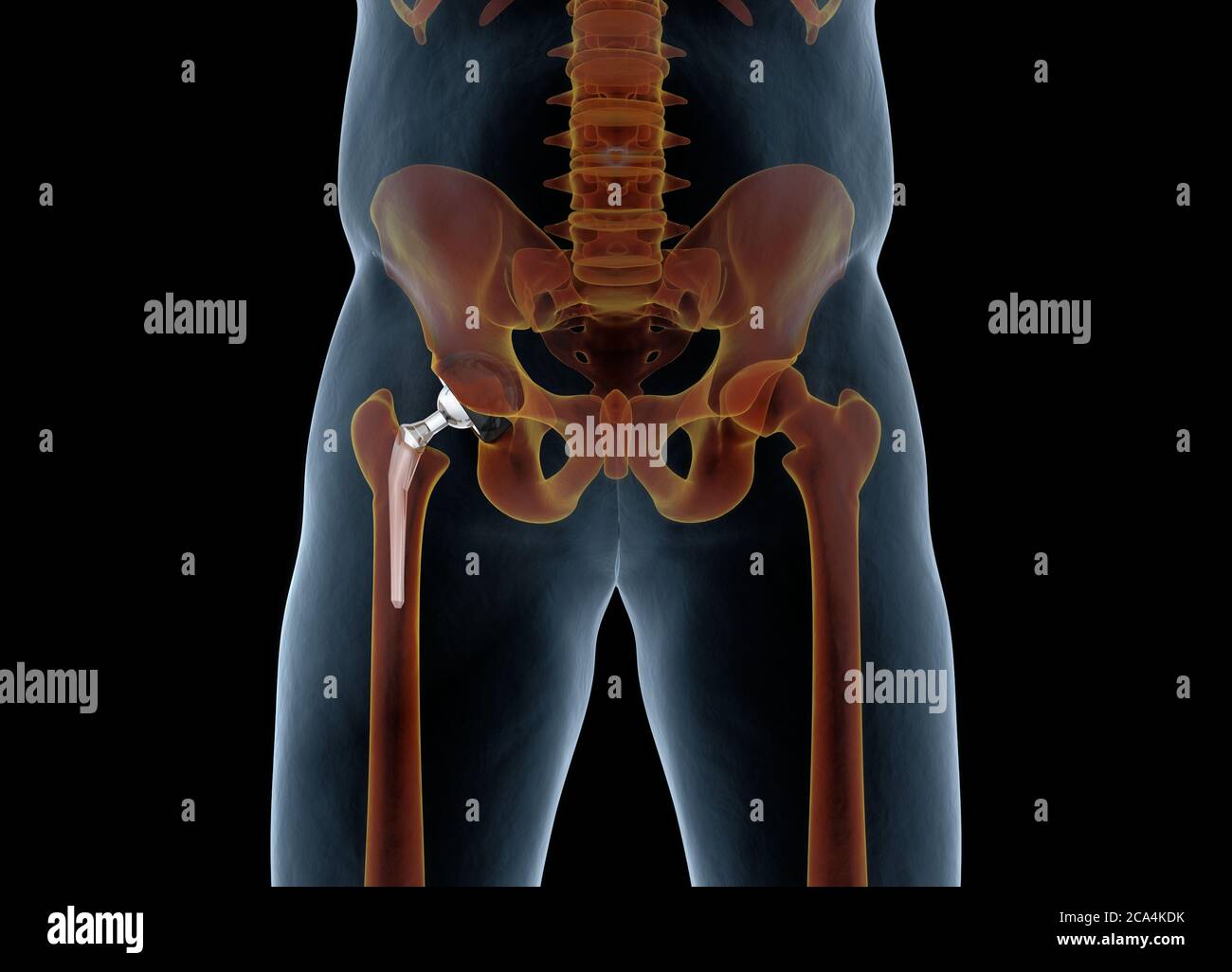 Medically accurate illustration of the hip replacement. 3d illustration ...