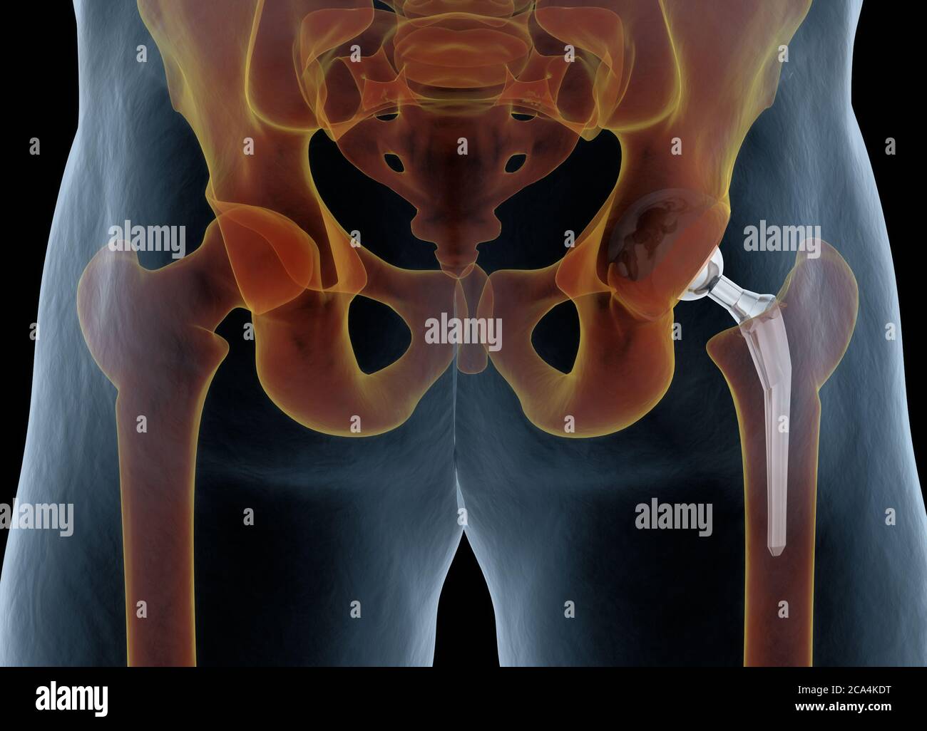 Medically accurate illustration of the hip replacement. 3d illustration ...