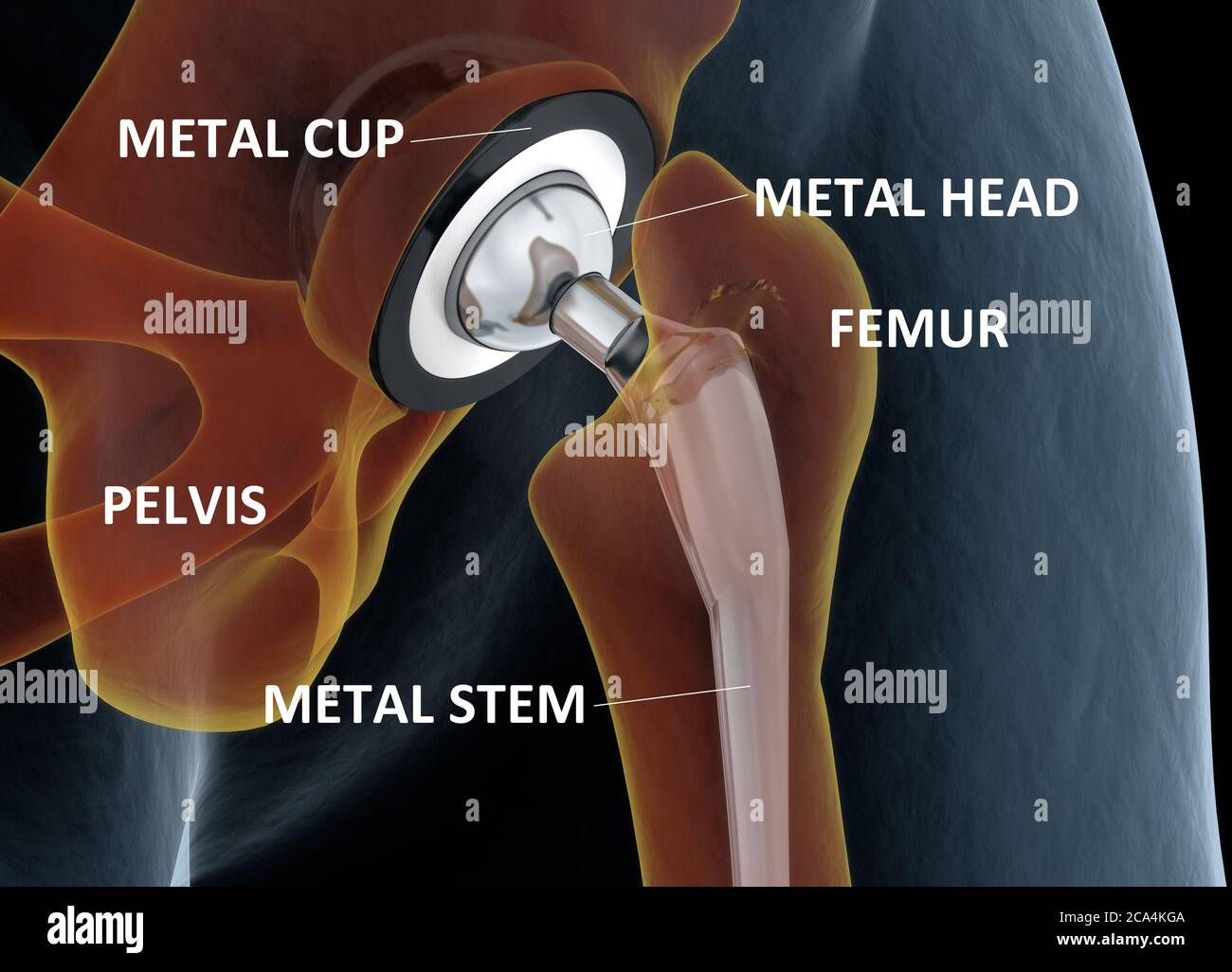 Medically accurate illustration of the hip replacement. 3d illustration ...