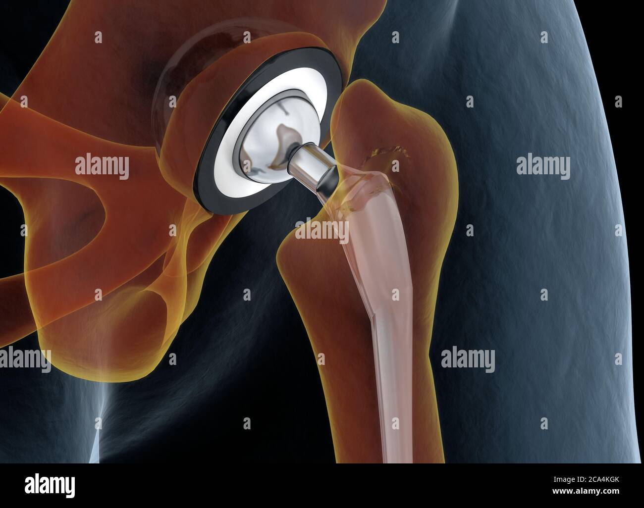 Medically accurate illustration of the hip replacement. 3d illustration ...