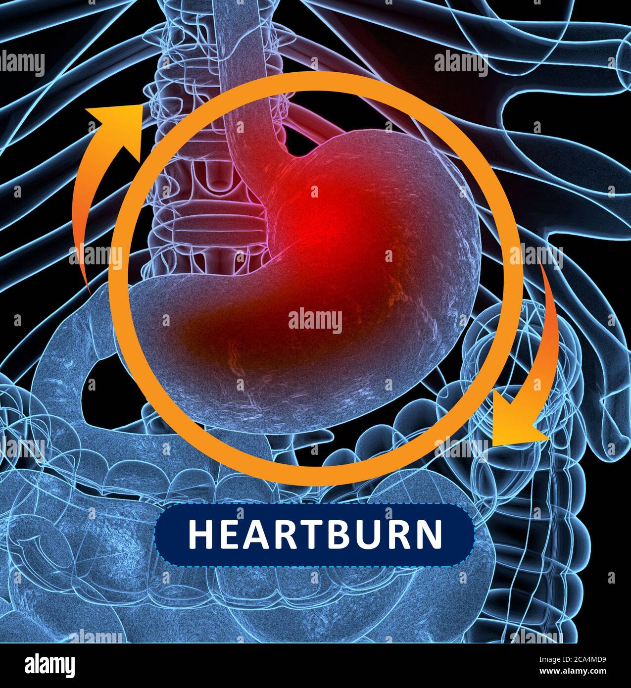 Acid reflux, GERD. Gastroesophageal reflux disease. Stomach and ...