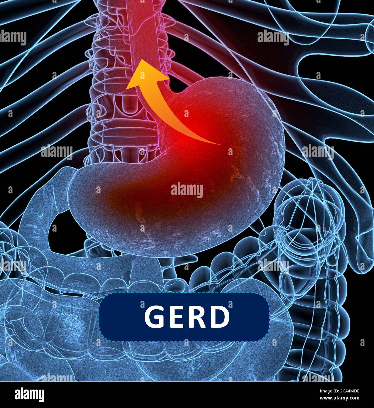 Gastroesophageal reflux disease hi-res stock photography and images - Alamy