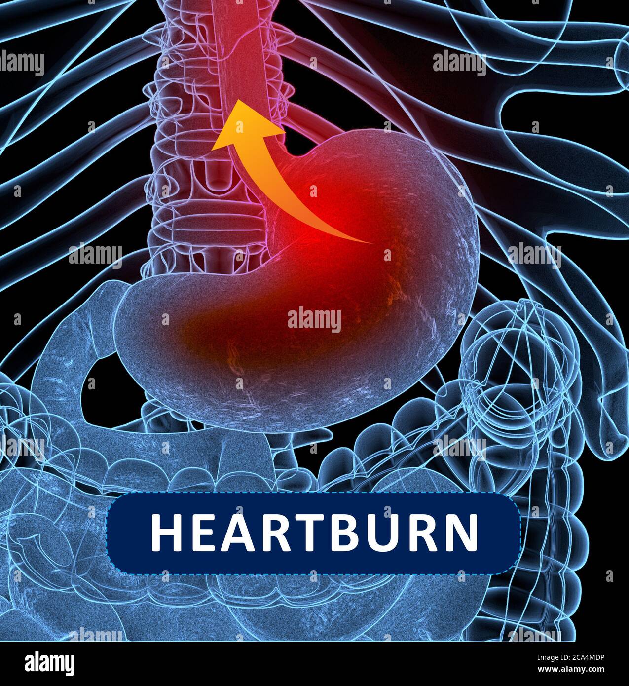 Acid reflux, GERD. Gastroesophageal reflux disease. Stomach and ...