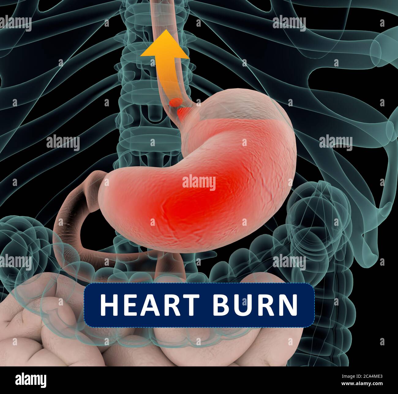Acid Reflux Gerd Gastroesophageal Reflux Disease Stomach And