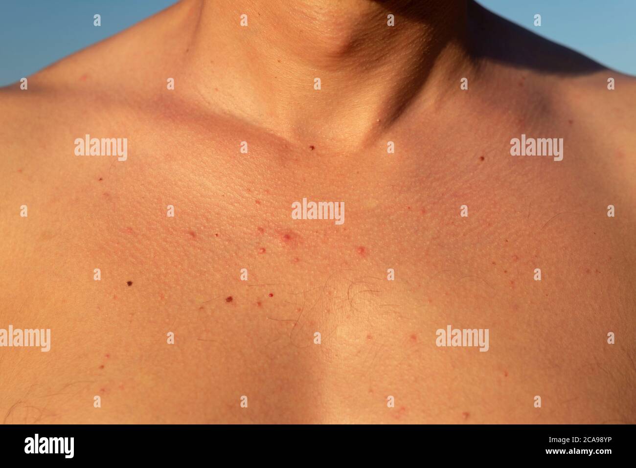 Red Acne A Rash In The Chest Area Of A Guy Closeup Unhealthy Skin Dermatosis Purulent