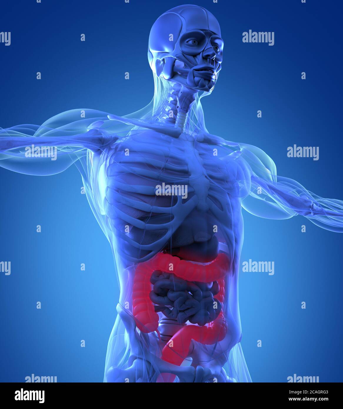 Large intestine diverticulitis hi-res stock photography and images - Alamy