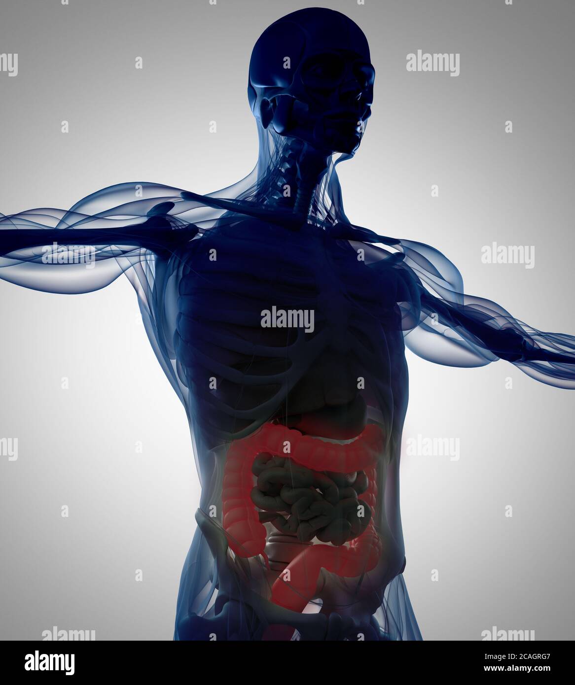 Large intestine diverticulitis hi-res stock photography and images - Alamy