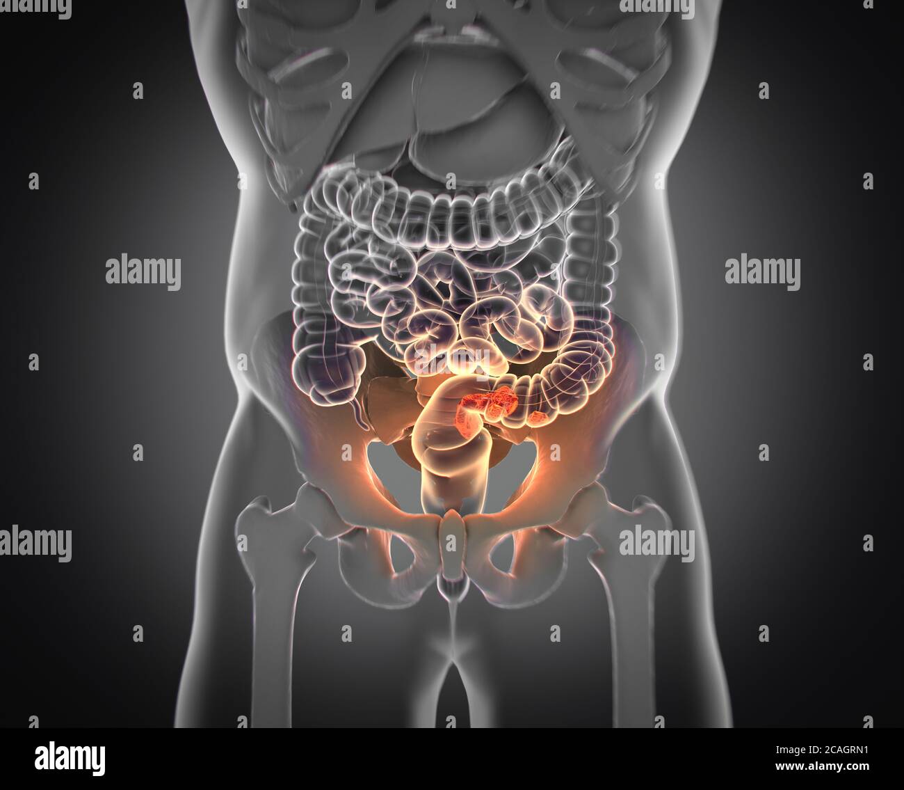 Colorectal cancer,medical anatomical illustration.3d illustration Stock ...