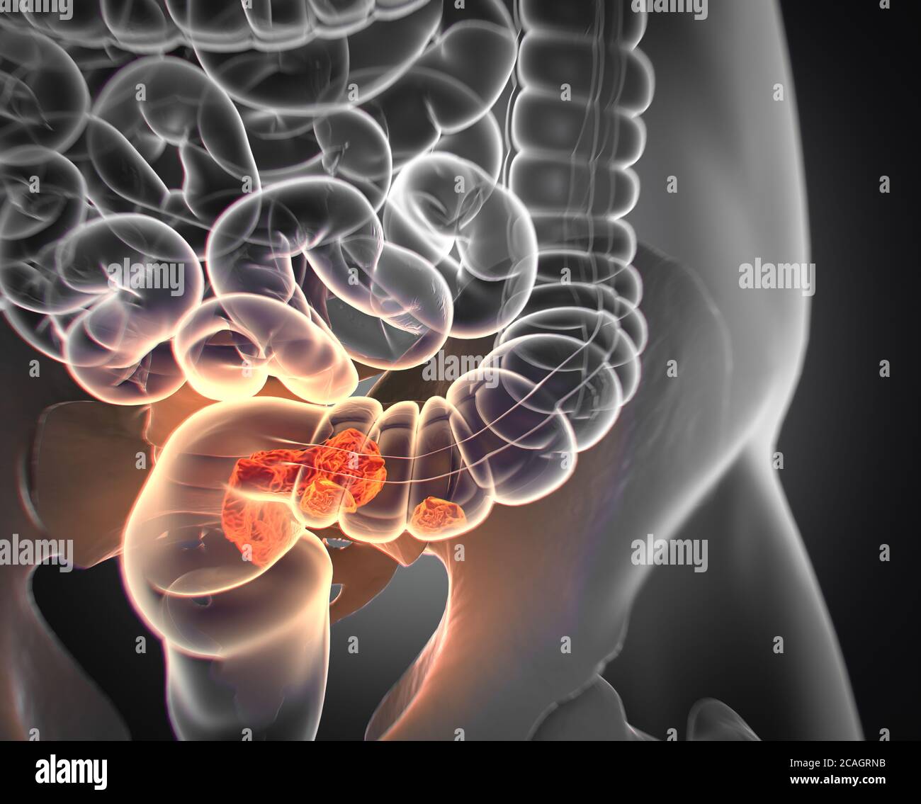 Colorectal Cancer Medical Anatomical Illustration 3d Illustration Stock