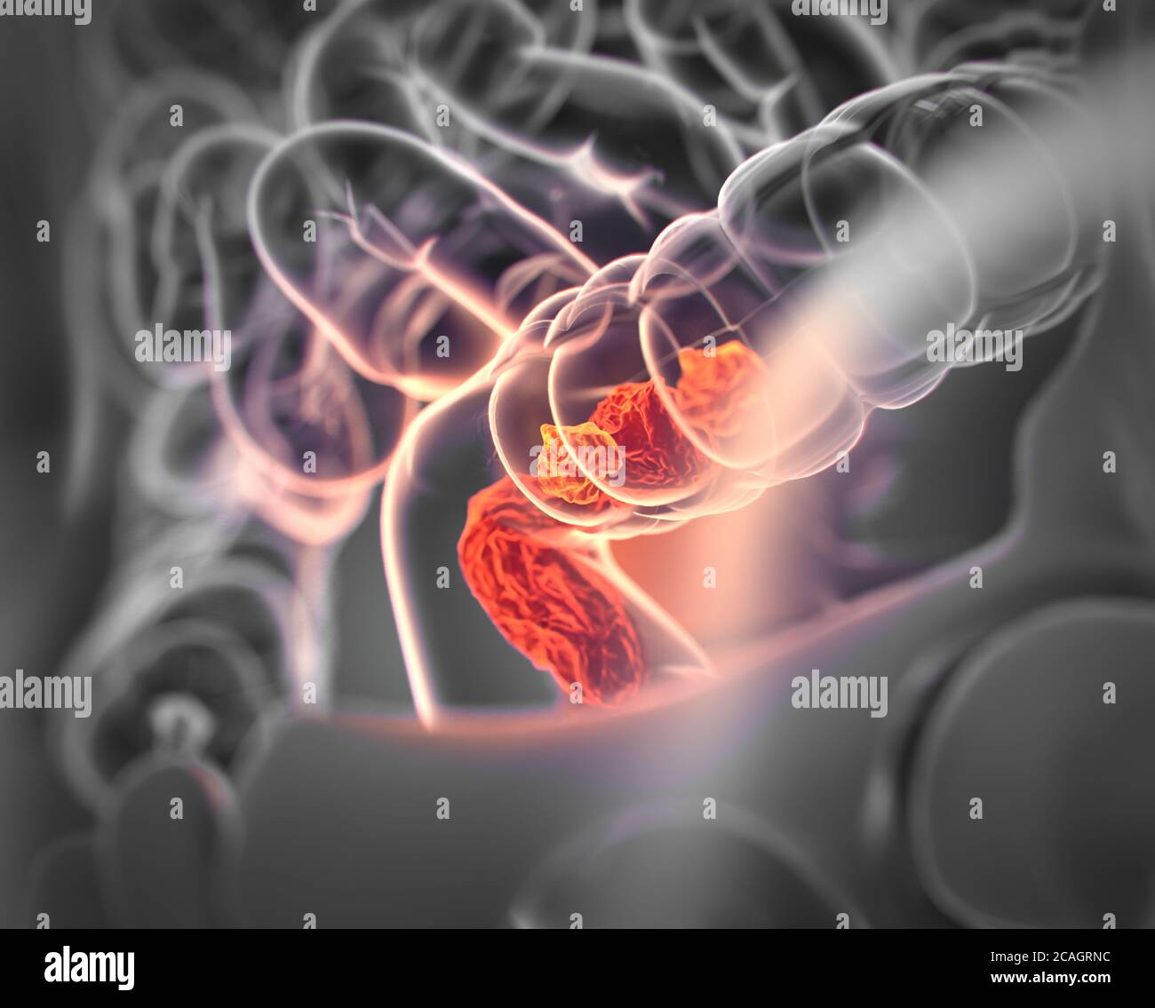 Colorectal cancer,medical anatomical illustration.3d illustration Stock ...