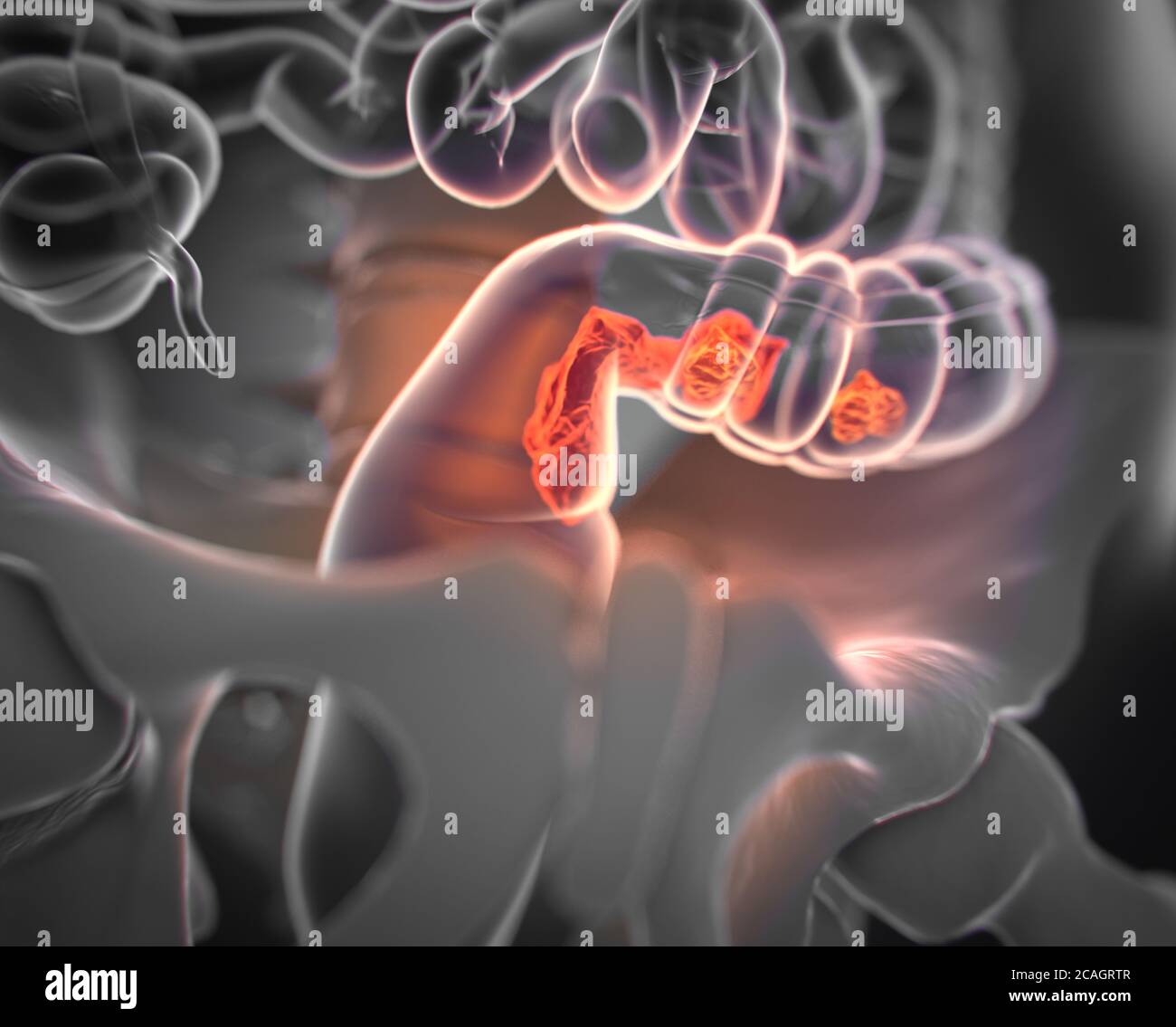 Colorectal cancer,medical anatomical illustration.3d illustration Stock ...