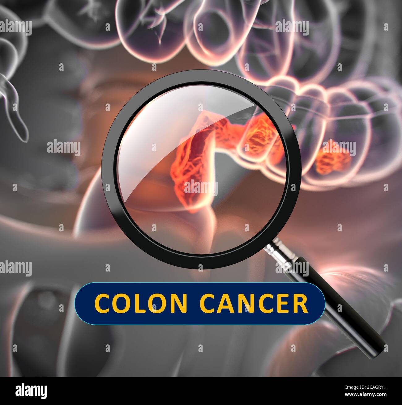 Colorectal cancer,medical anatomical illustration.3d illustration Stock ...