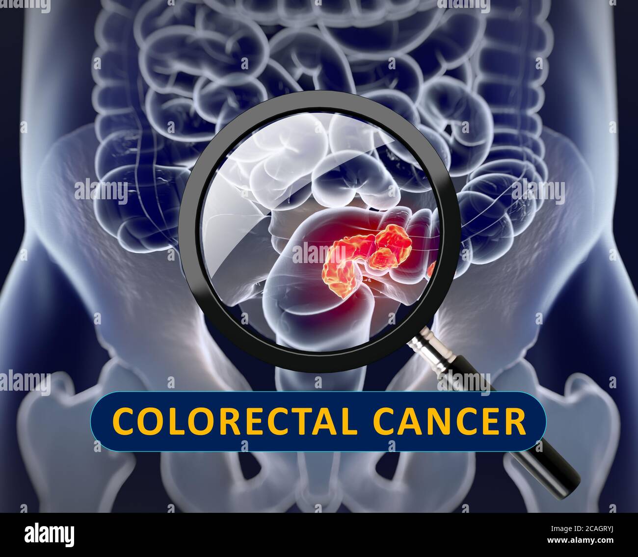 Colorectal cancer,medical anatomical illustration.3d illustration Stock ...