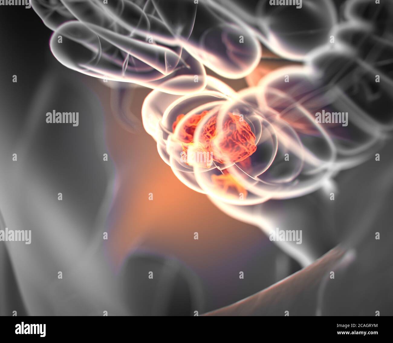 Colorectal cancer,medical anatomical illustration.3d illustration Stock ...