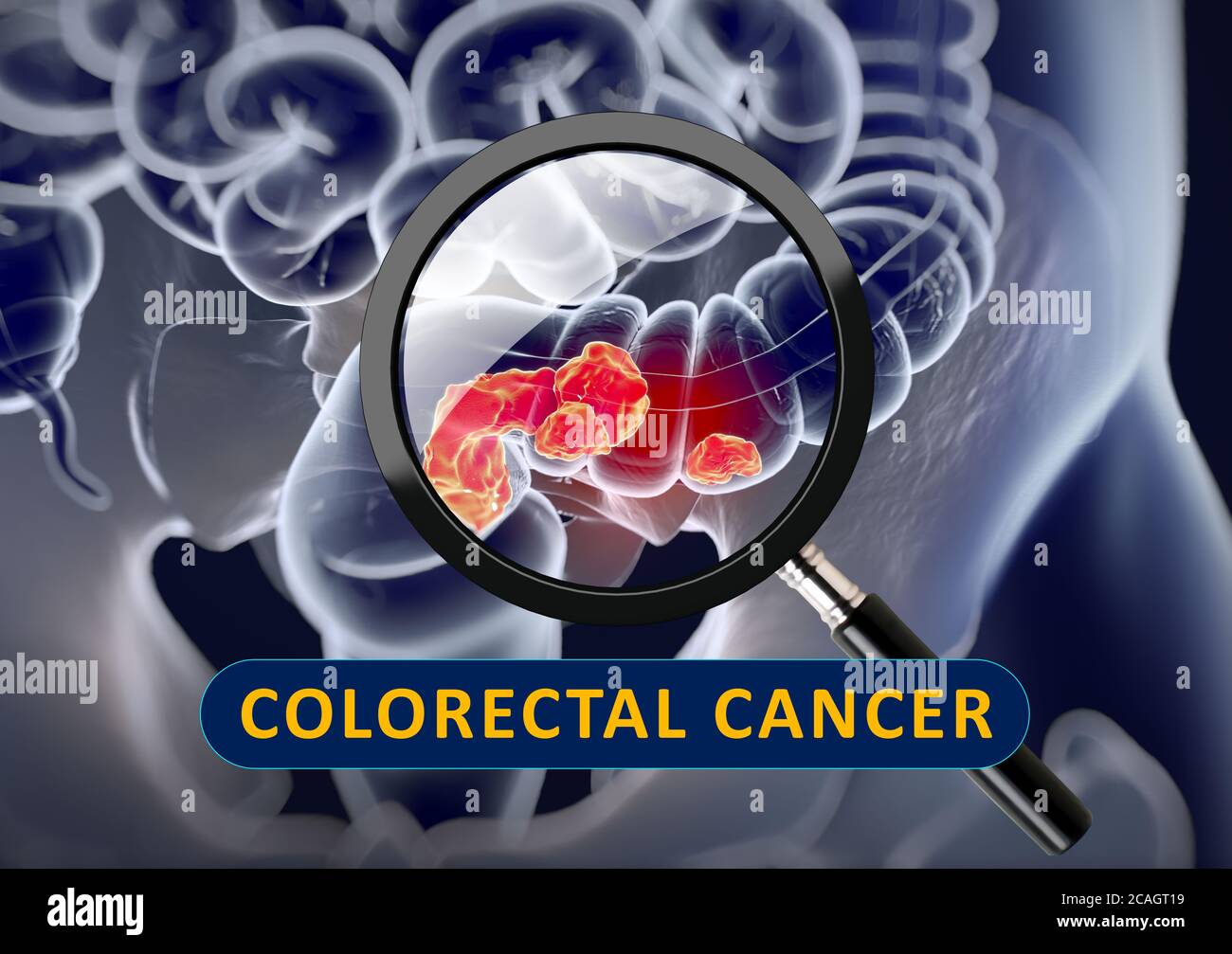 Colorectal Cancer High Resolution Stock Photography and Images - Alamy