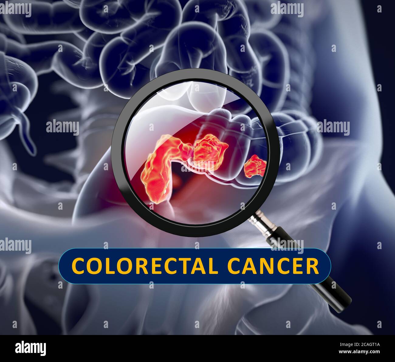 Colorectal cancer,medical anatomical illustration.3d illustration Stock ...