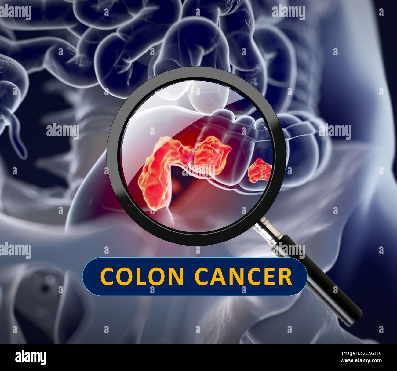 Colorectal cancer,medical anatomical illustration.3d illustration Stock ...
