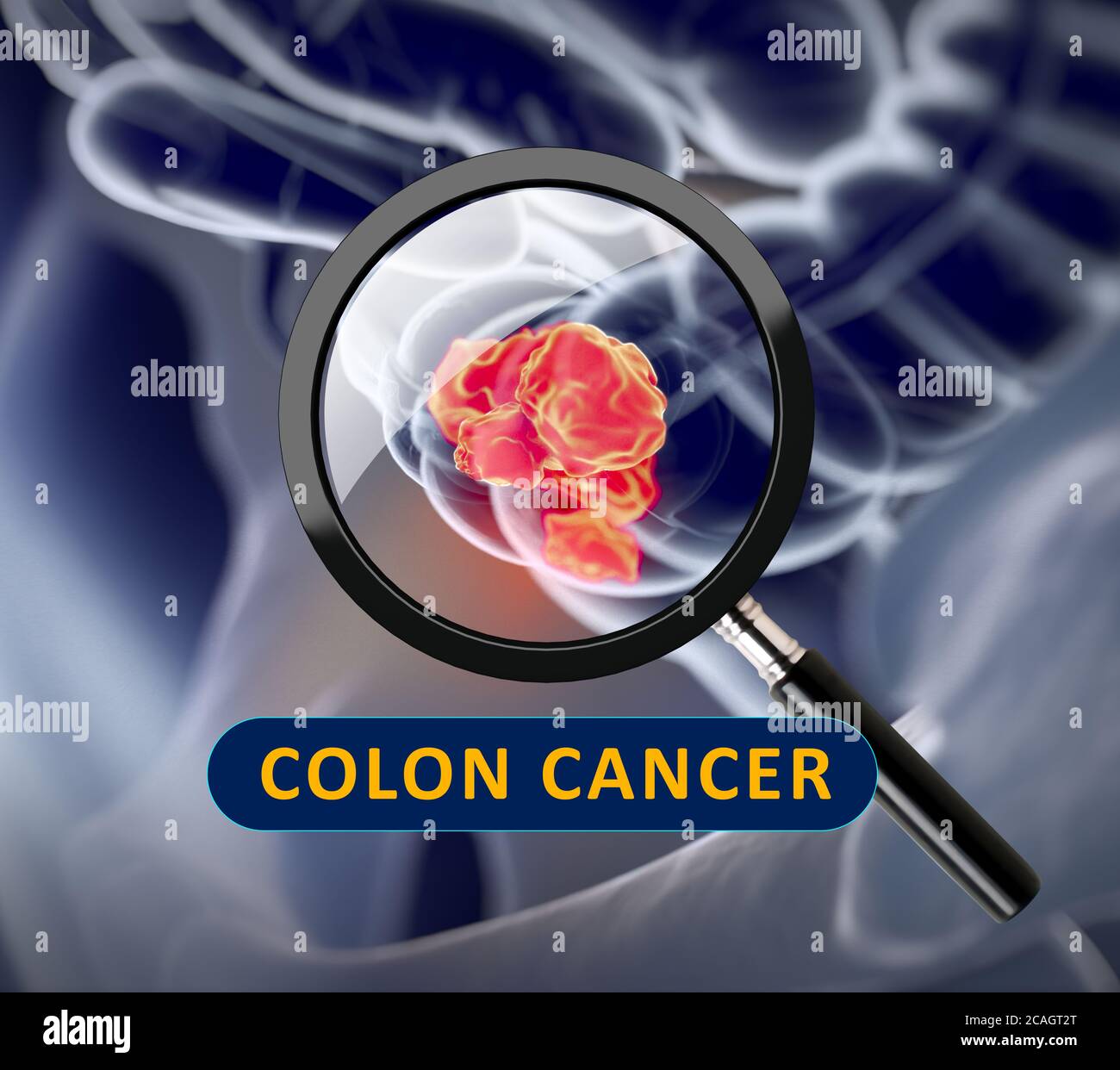 Colorectal cancer,medical anatomical illustration.3d illustration Stock ...