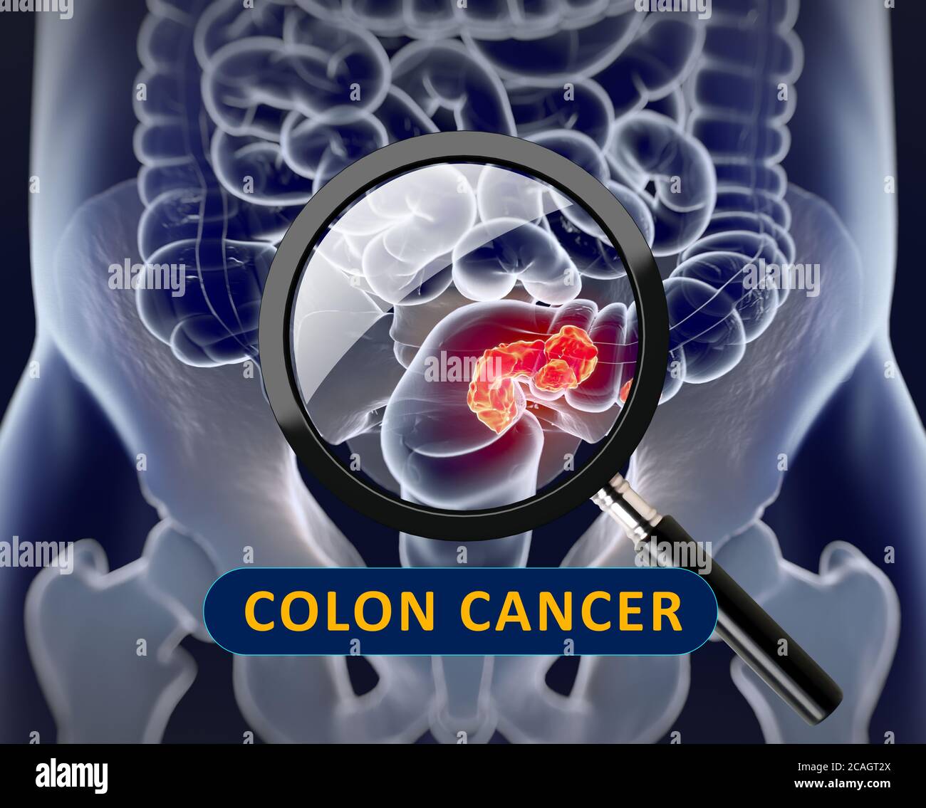 Colorectal cancer,medical anatomical illustration.3d illustration Stock ...