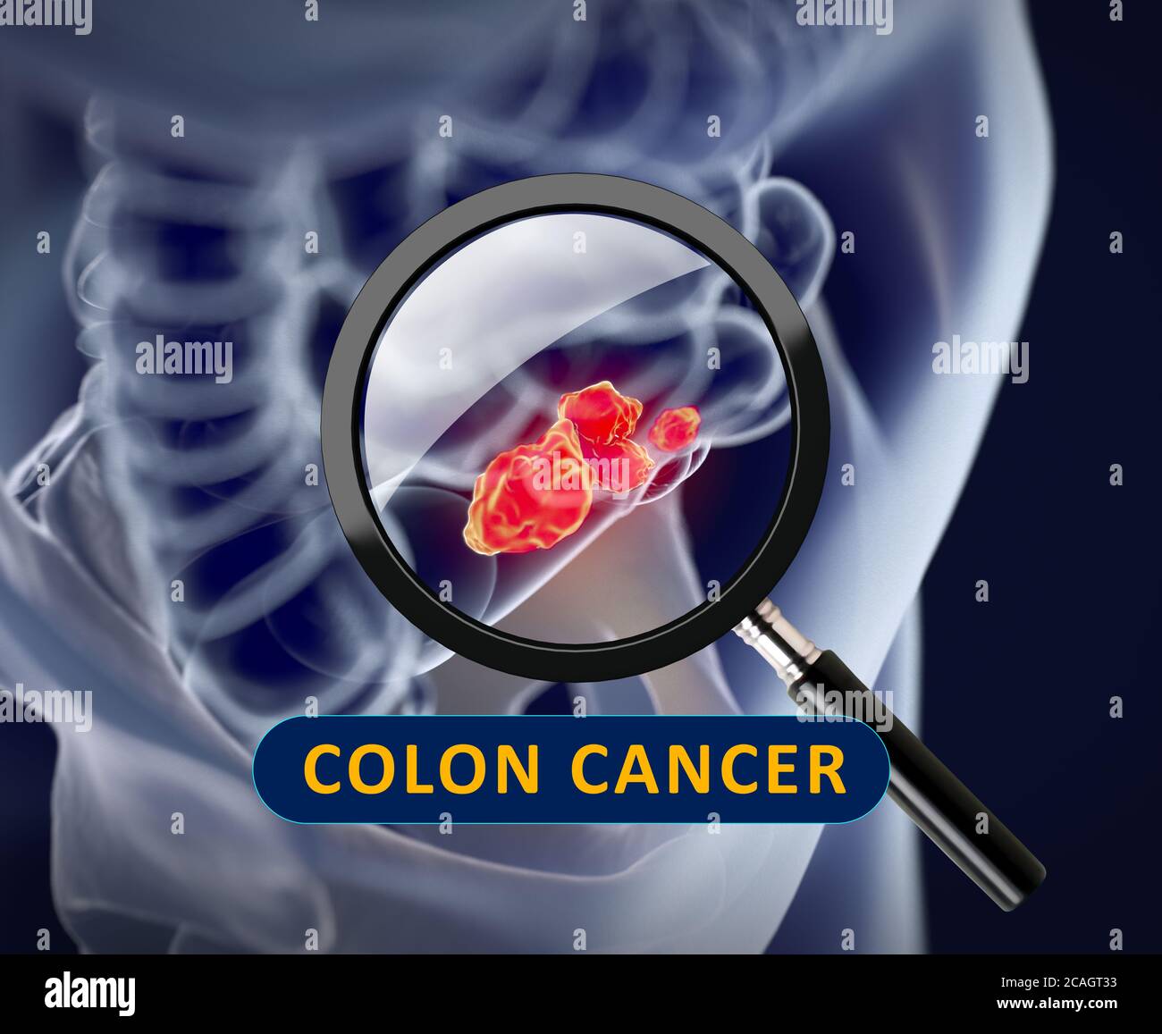 Colorectal cancer,medical anatomical illustration.3d illustration Stock ...
