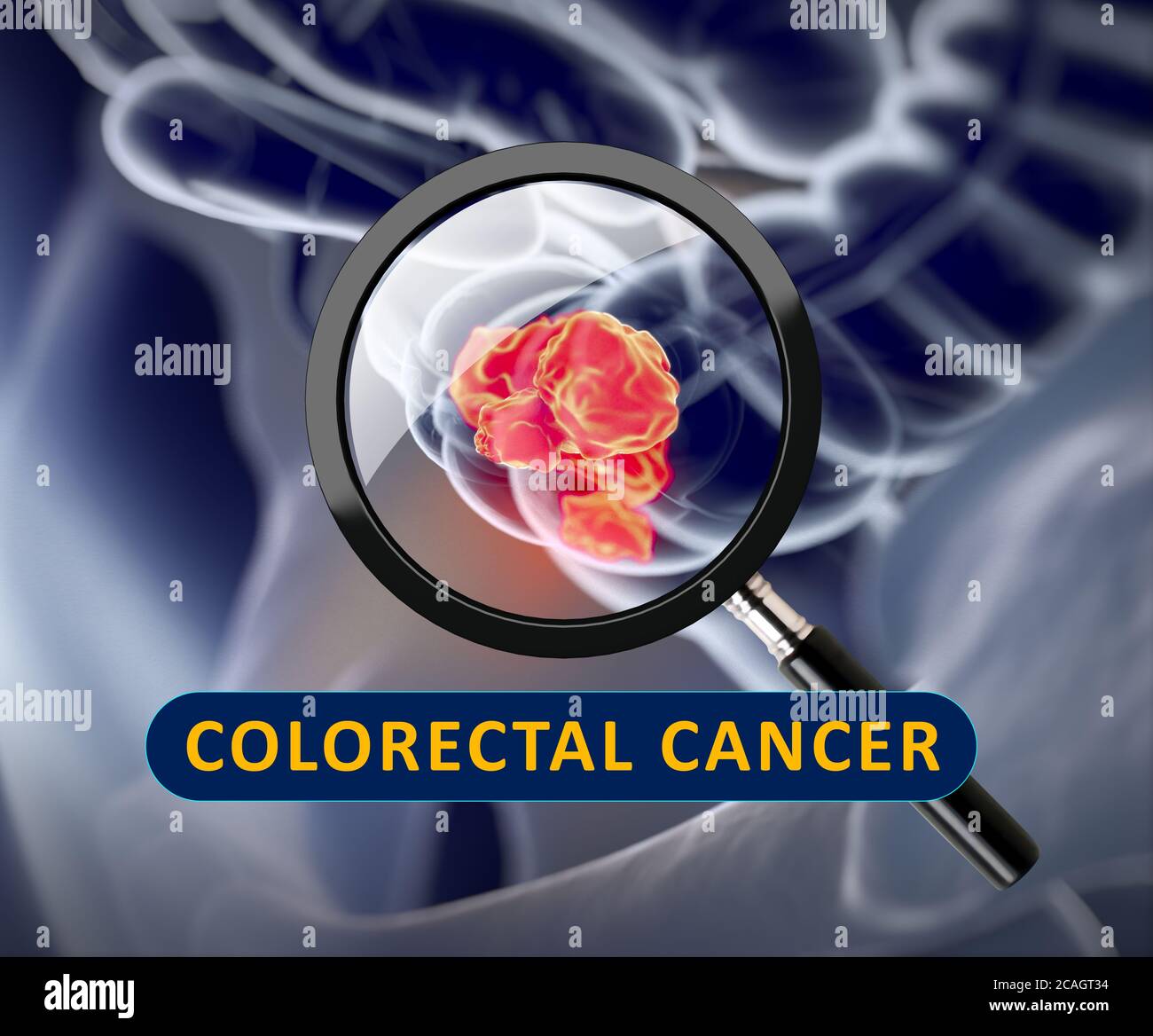 Colorectal cancer,medical anatomical illustration.3d illustration Stock ...