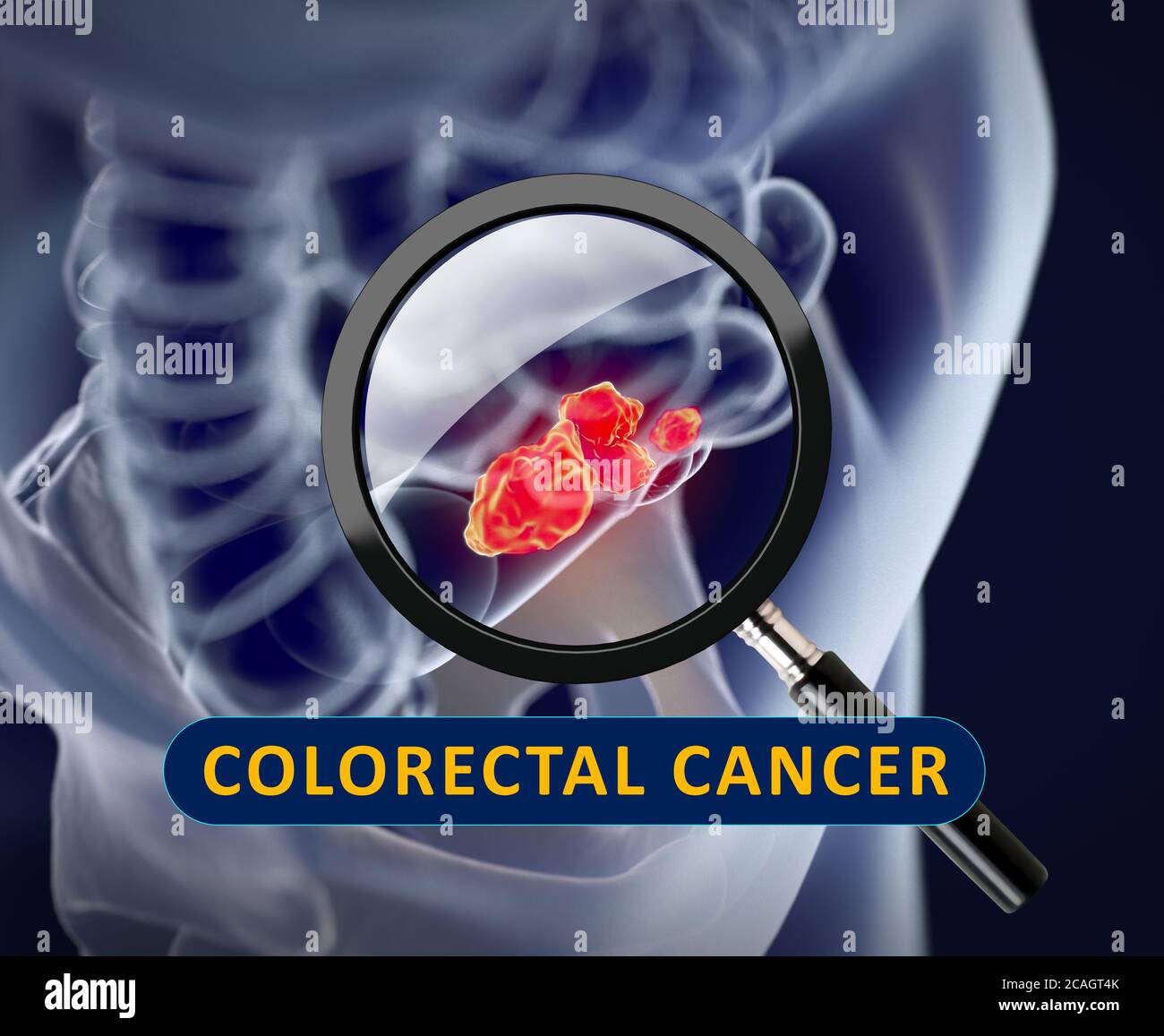 Colorectal cancer,medical anatomical illustration.3d illustration Stock ...
