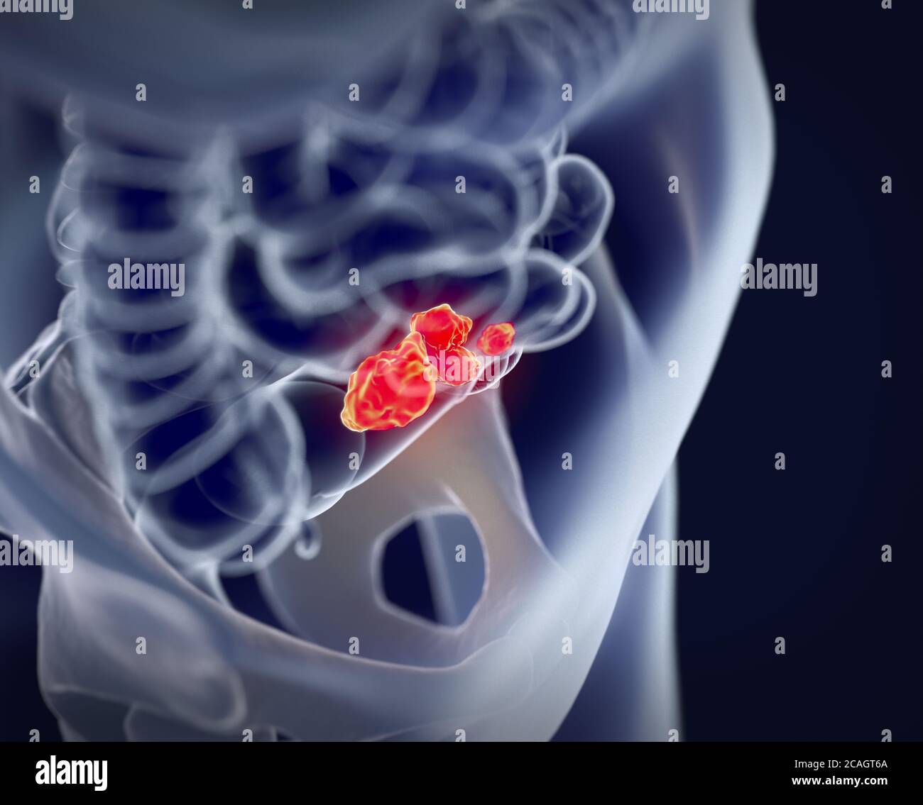 Colorectal cancer,medical anatomical illustration.3d illustration Stock ...