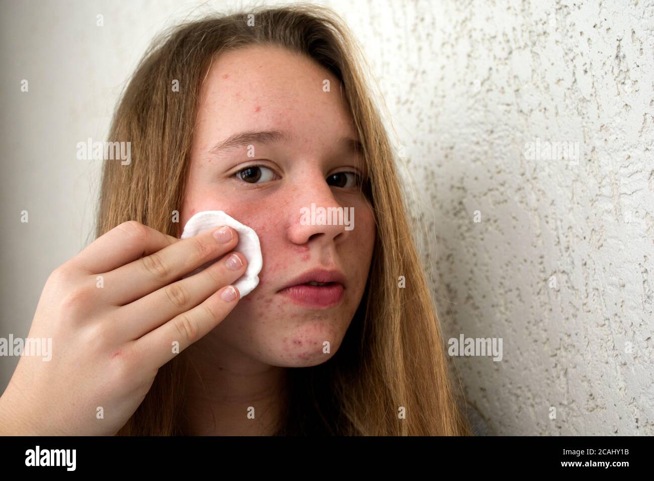 A teenage girl has acne on her face, problem skin. Acne on the face of ...