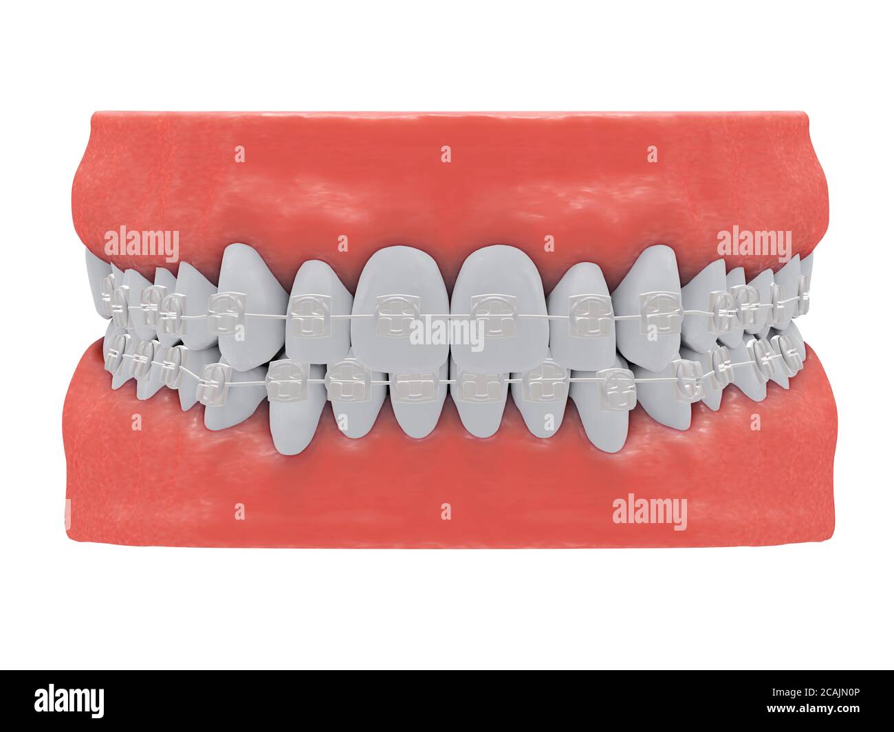 Human jaws with healthy teeth and invisible ceramic braces, front view ...