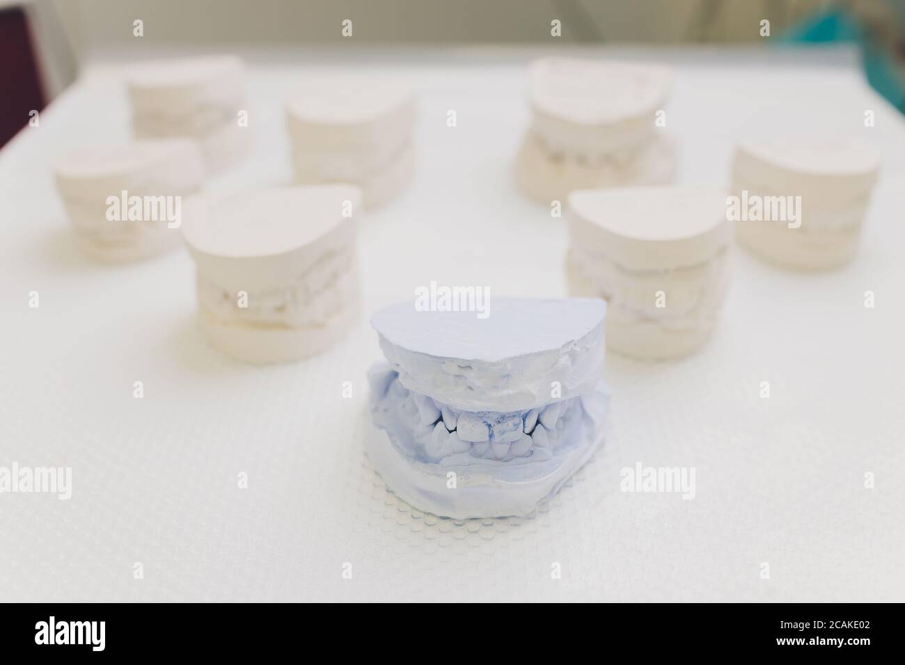 Dental casting gypsum model of human jaws. Crooked teeth and distal ...