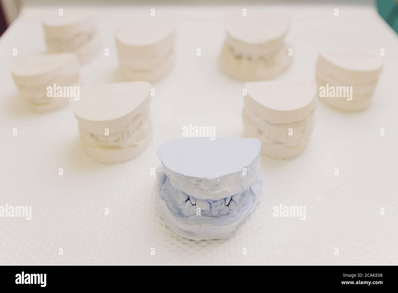 Dental casting gypsum model of human jaws. Crooked teeth and distal ...