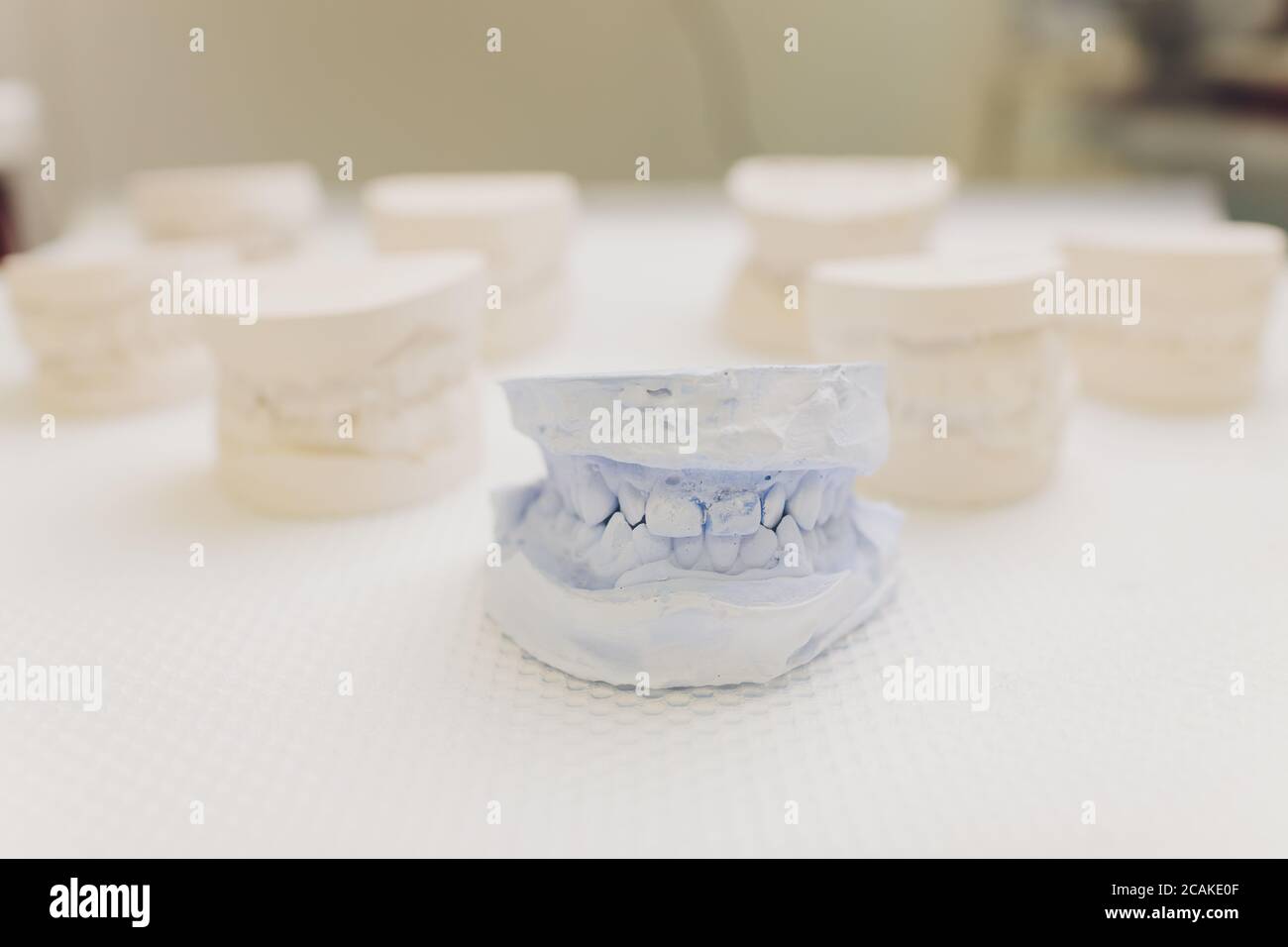 Dental casting gypsum model of human jaws. Crooked teeth and distal ...