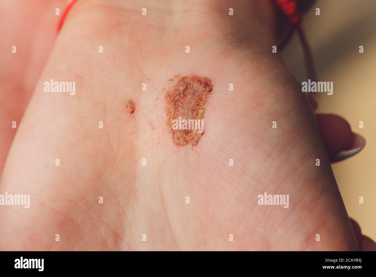 Skin Abrasion High Resolution Stock Photography and Images - Alamy
