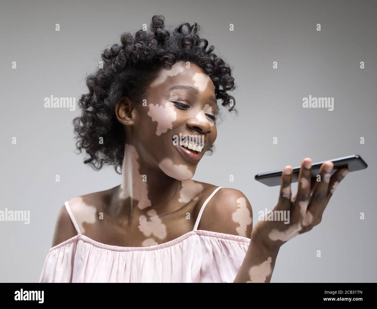 Portrait of african-american woman with vitiligo skin. Special skin ...