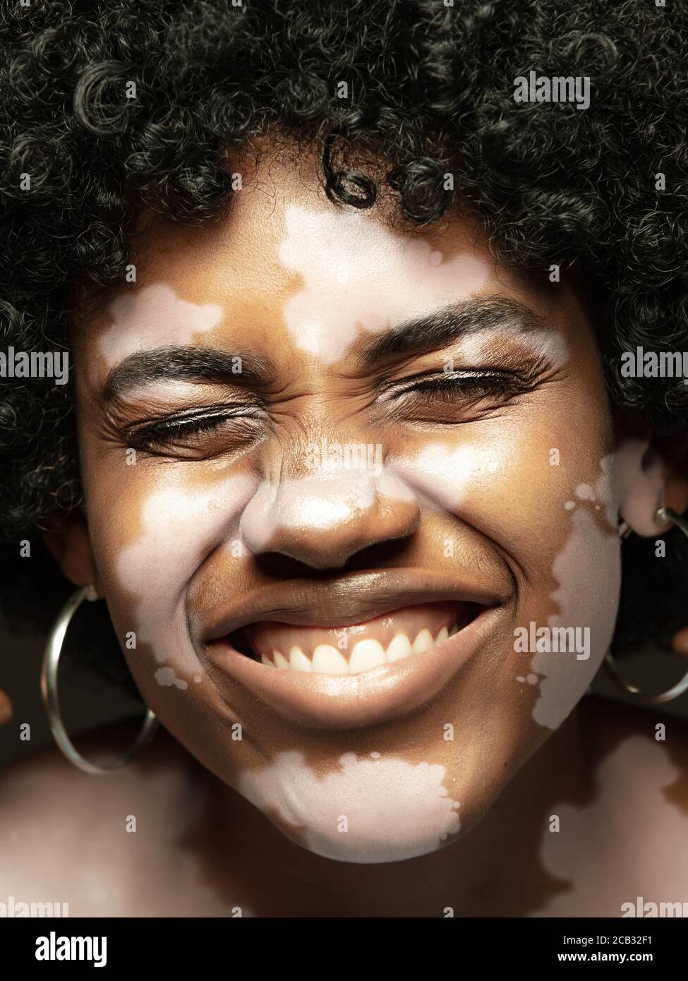 Portrait of african-american woman with vitiligo skin. Special skin ...