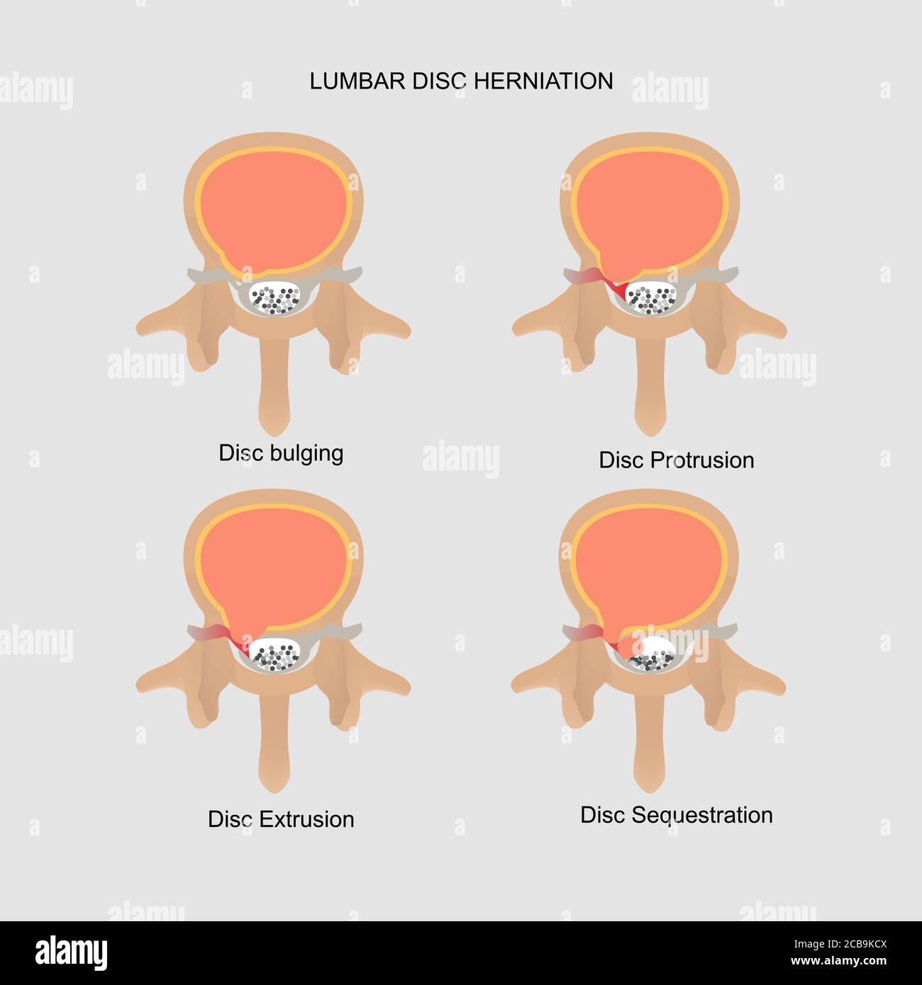 Herniated disc Stock Vector Images - Alamy