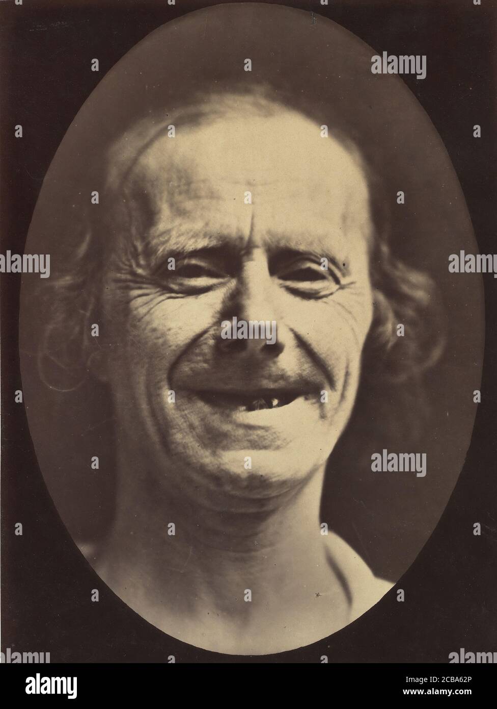 Figure 52: Voluntary retraction of the lower lip, 1854-56, printed 1862 ...