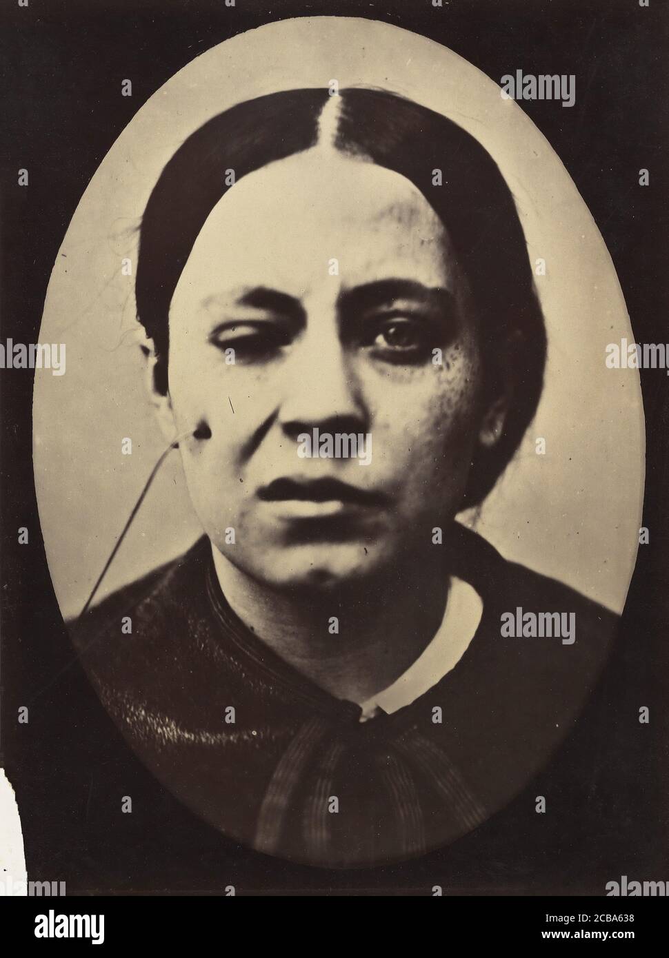 Figure 50: Affected weeping and face in repose, 1854-56, printed 1862 ...