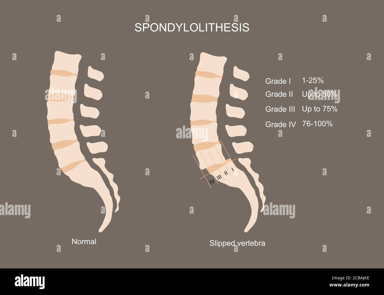 Normal lumbar spine hi-res stock photography and images - Alamy